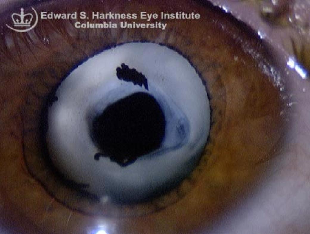 Aphakia and Soemmering's Ring Formation | Vagelos College of Physicians ...