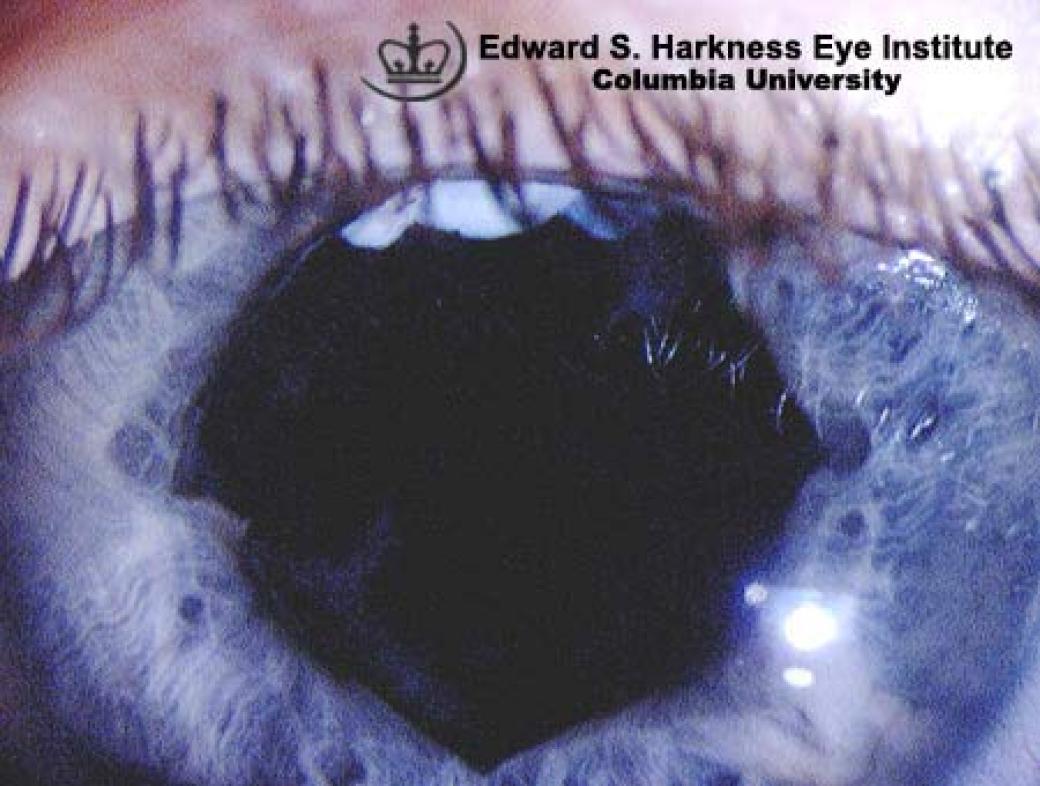 Atonic Pupil | Vagelos College of Physicians and Surgeons