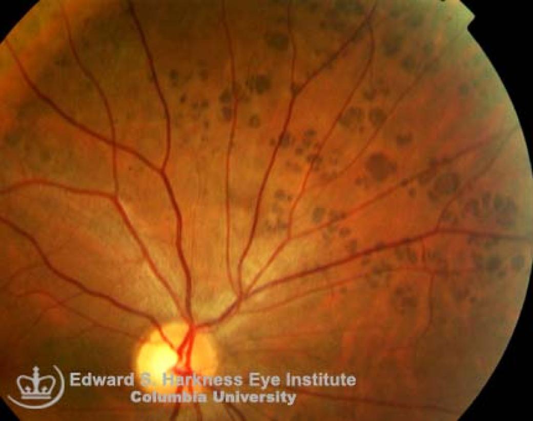 "Bear Tracks" CHRPE | Vagelos College of Physicians and Surgeons