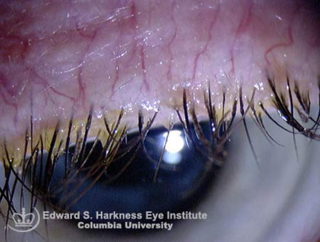 Blepharitis | Vagelos College of Physicians and Surgeons