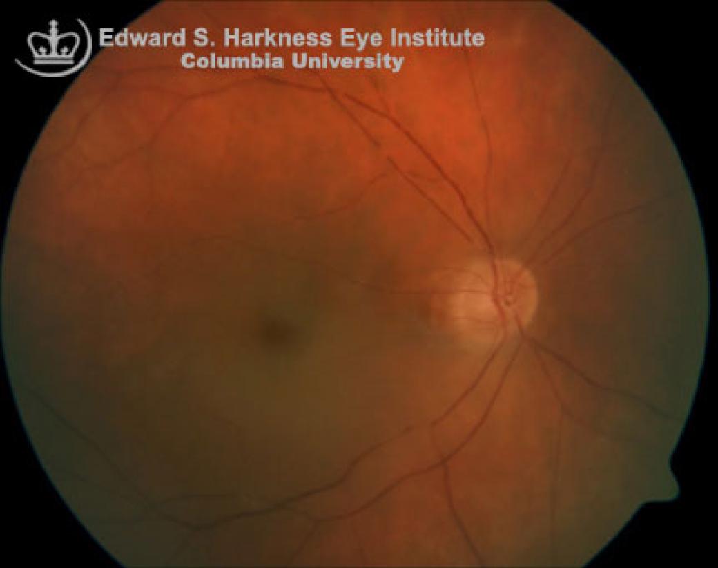 Central Retinal Artery Occlusion (CRAO) | Vagelos College of Physicians ...