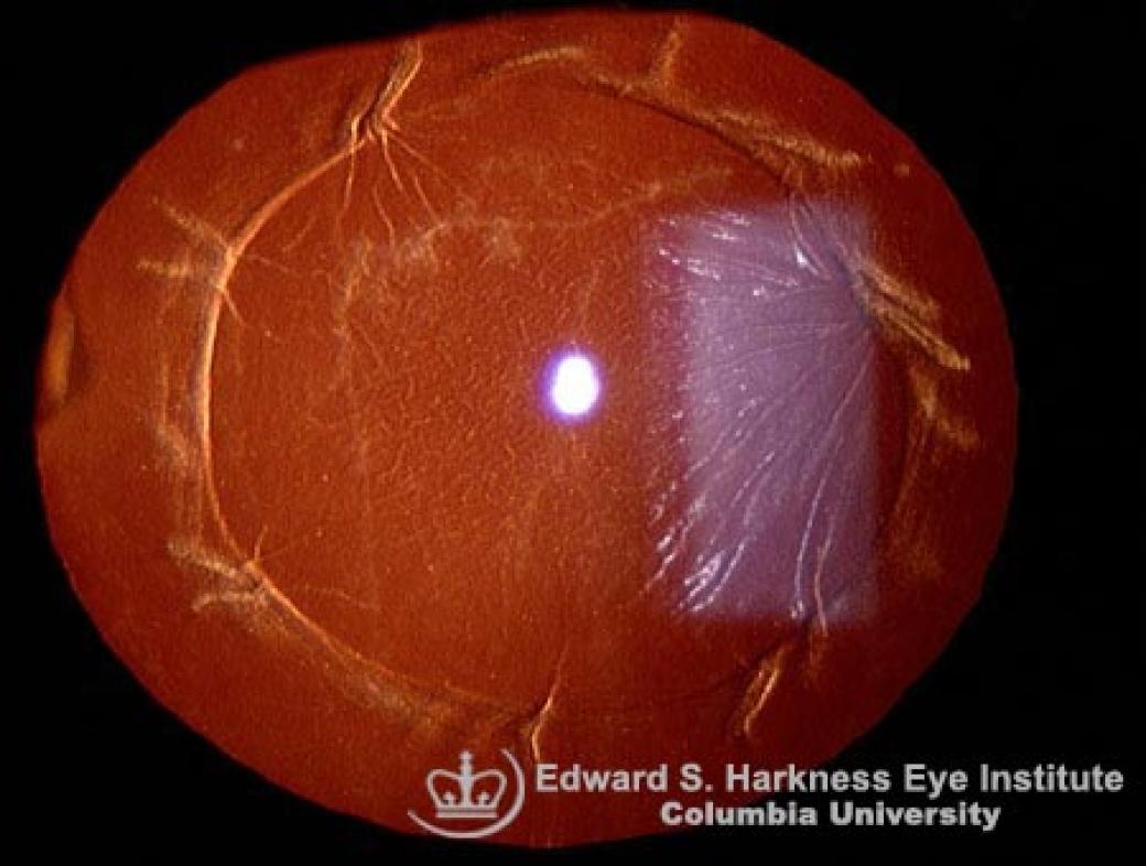 Continuous Circular Capsulorhexis | Vagelos College of Physicians and ...