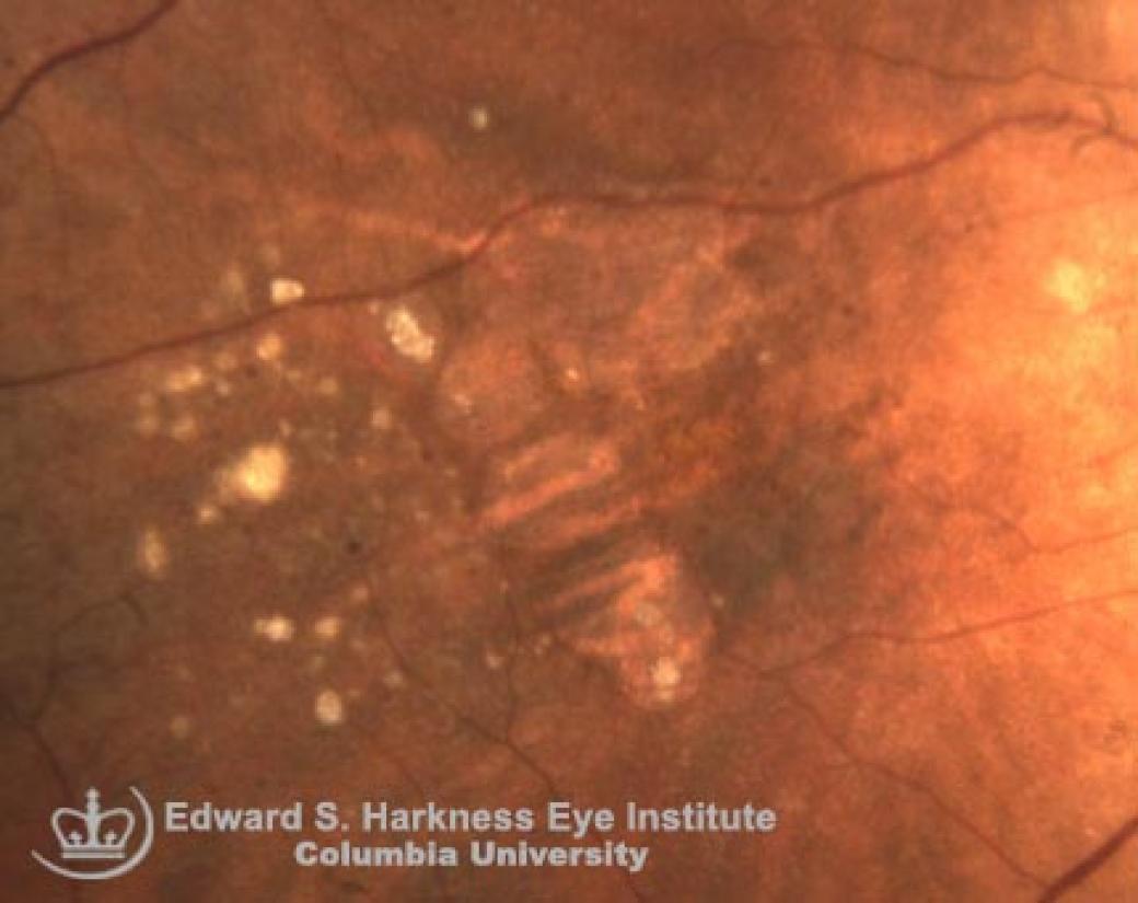 Geographic Atrophy and Calcified Drusen | Vagelos College of Physicians ...