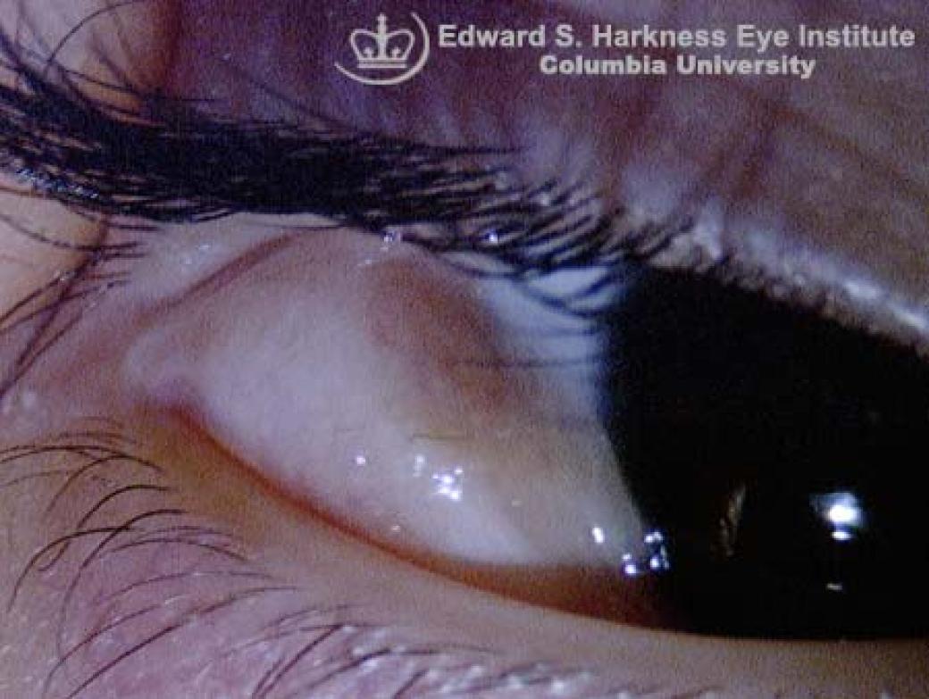 Goldenhar Syndrome | Vagelos College of Physicians and Surgeons