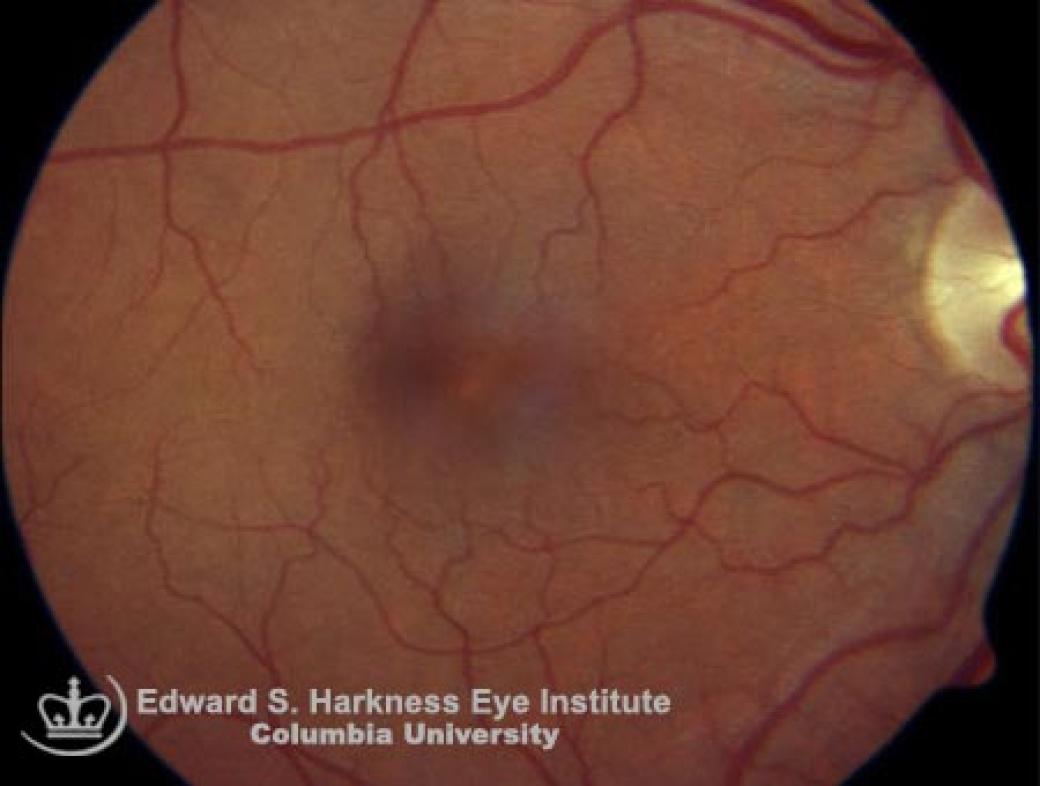 Irvine-Gass Syndrome | Vagelos College of Physicians and Surgeons