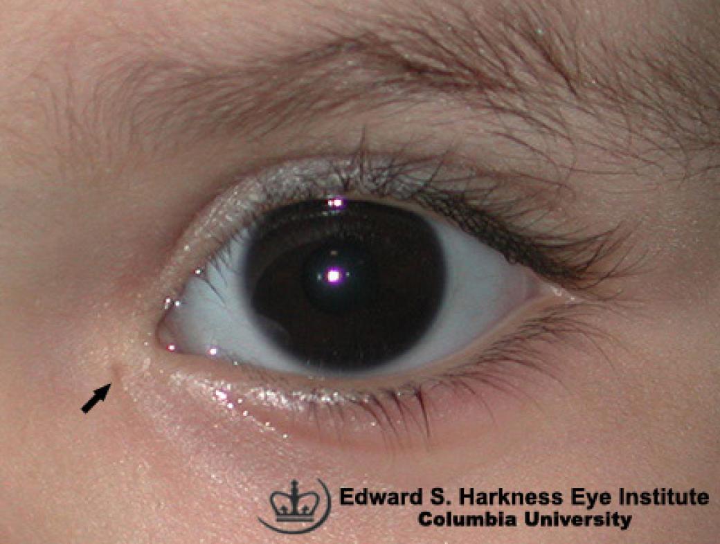 Lacrimal-Cutaneous Fistula | Vagelos College of Physicians and Surgeons