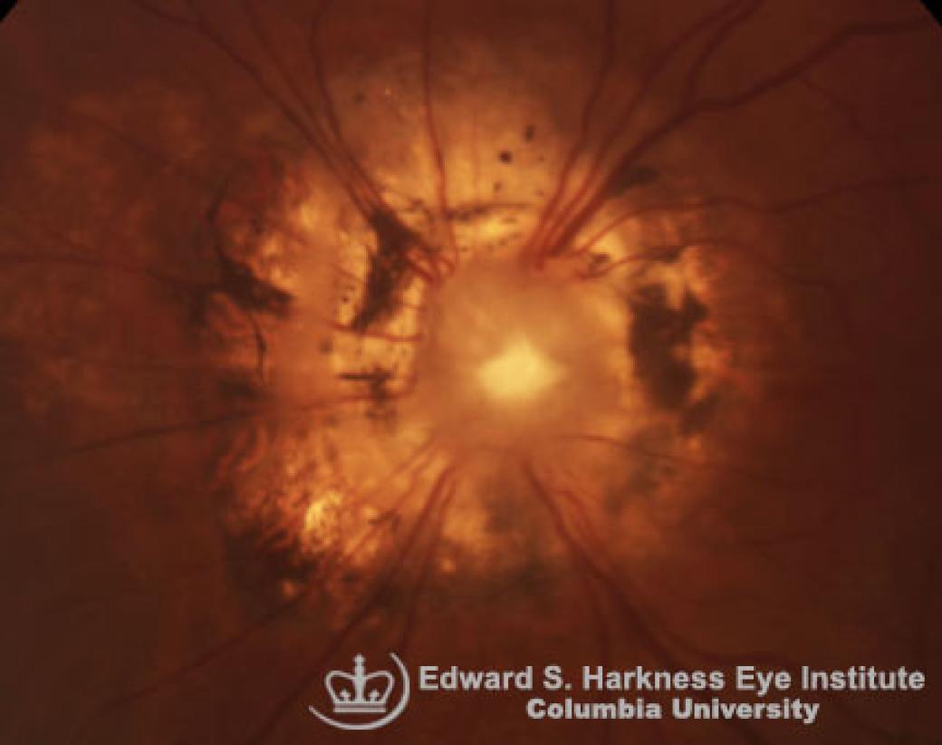 Morning Glory Anomaly | Vagelos College of Physicians and Surgeons