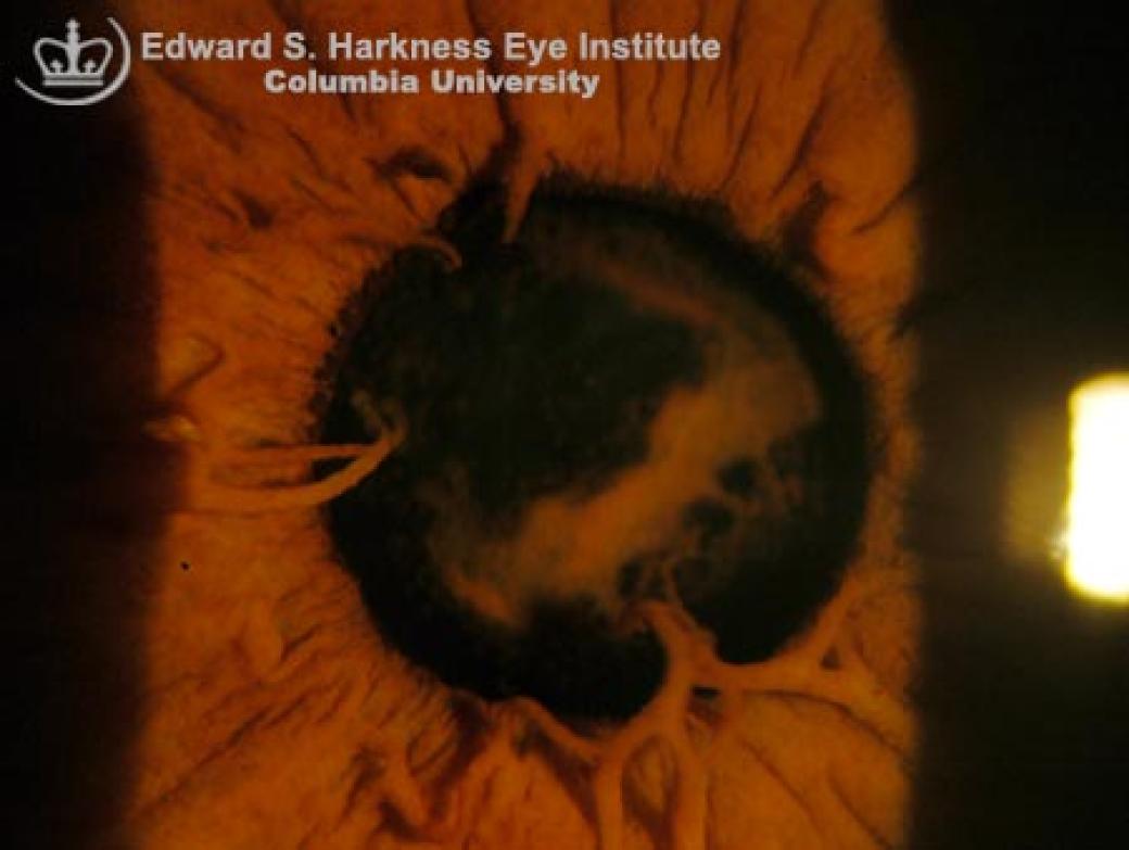 Persistent Pupillary Membrane | Vagelos College of Physicians and Surgeons