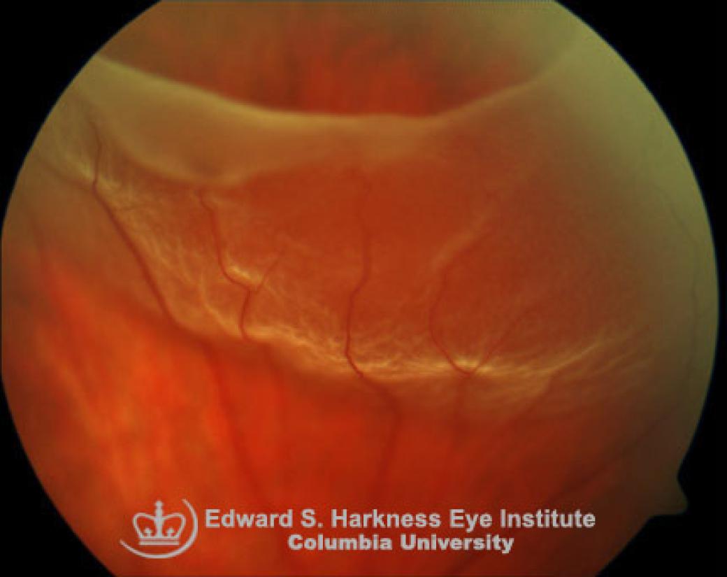 Retinal Detachment | Vagelos College of Physicians and Surgeons