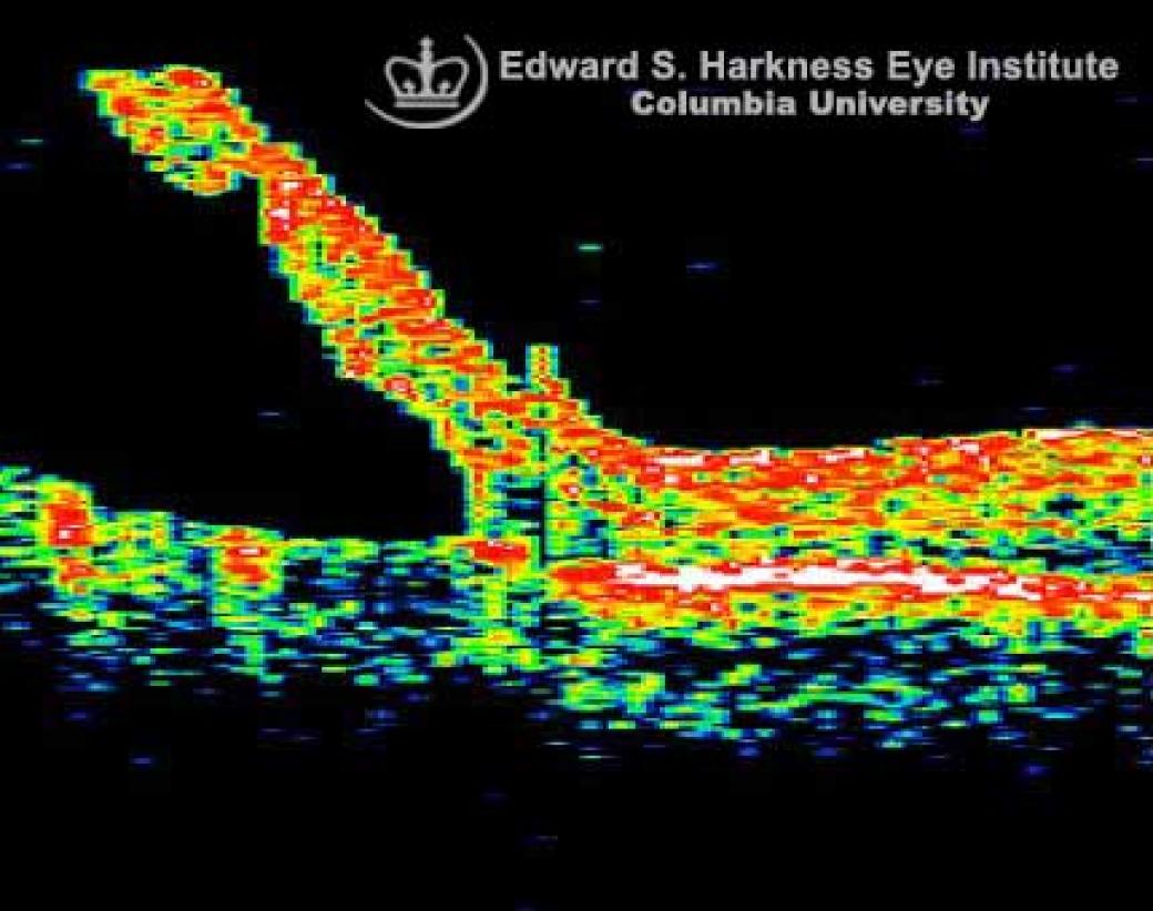 Retinoschisis (OCT Study) | Vagelos College of Physicians and Surgeons