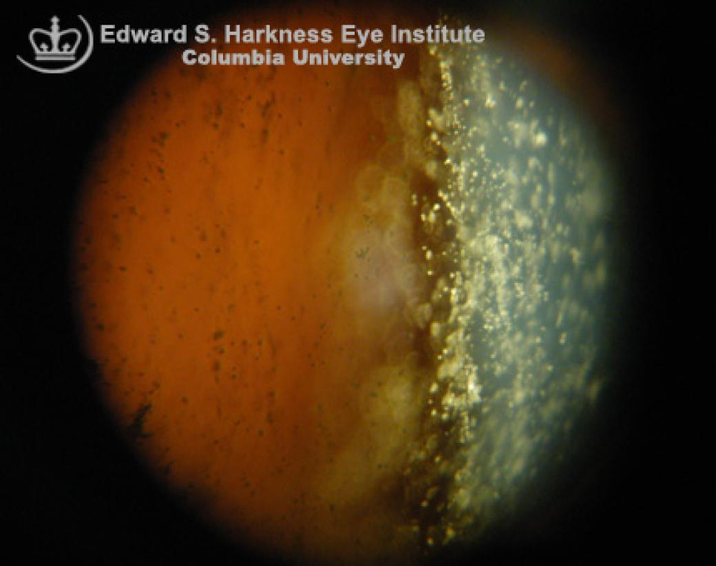 Asteroid Hyalosis | Vagelos College of Physicians and Surgeons