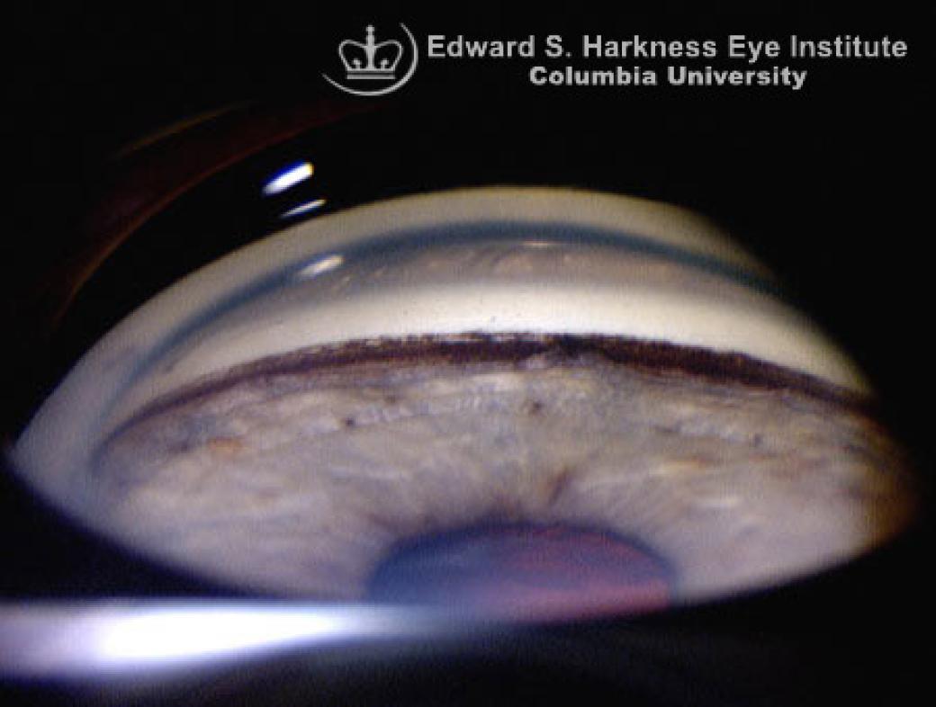 Pigment Dispersion Syndrome | Vagelos College of Physicians and Surgeons