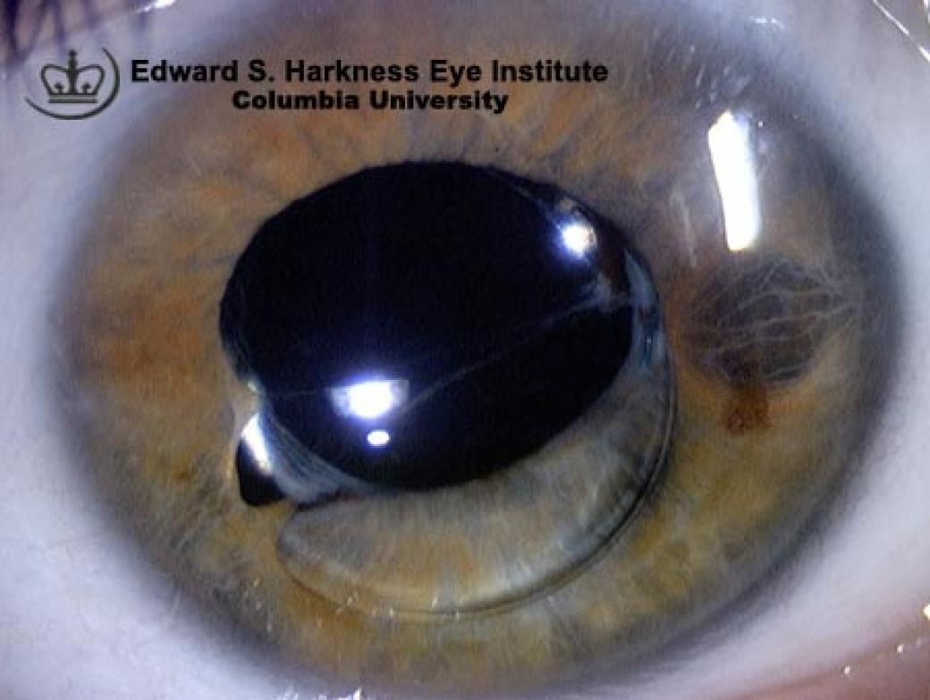Pupillary Block | Vagelos College of Physicians and Surgeons
