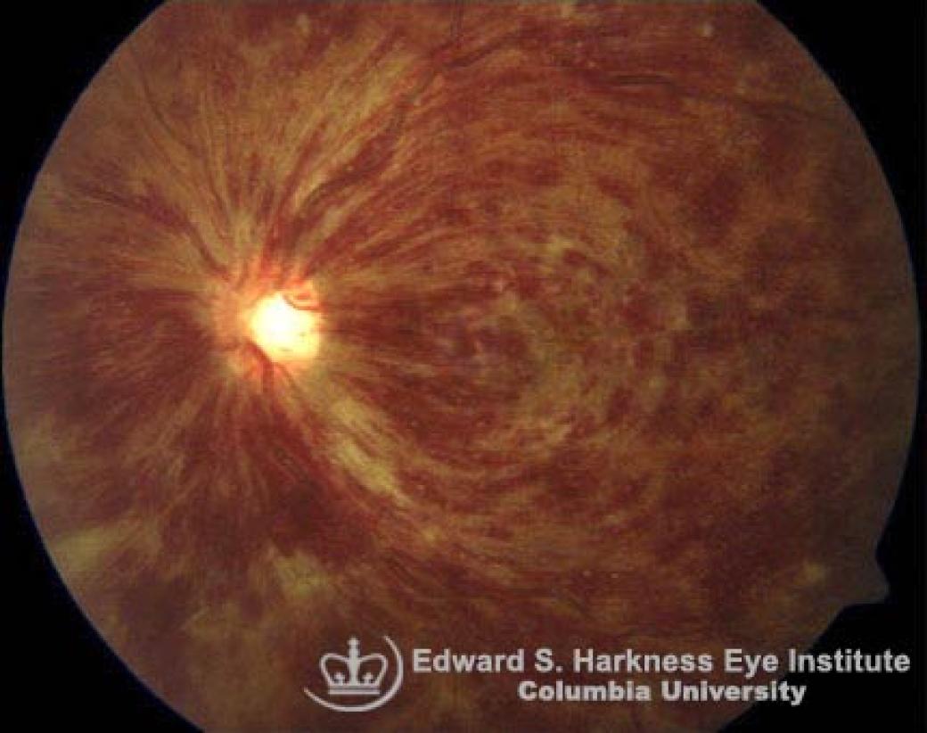 Central Retinal Vein Occlusion | Vagelos College of Physicians and Surgeons