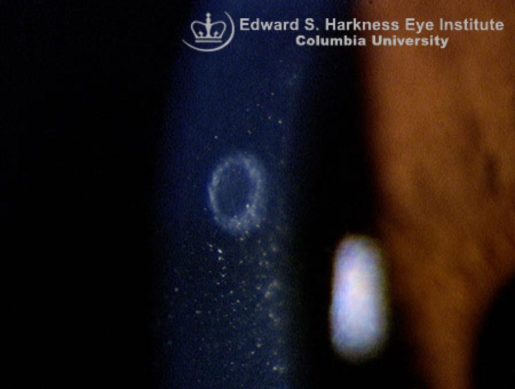 Coat's White Ring | Vagelos College of Physicians and Surgeons