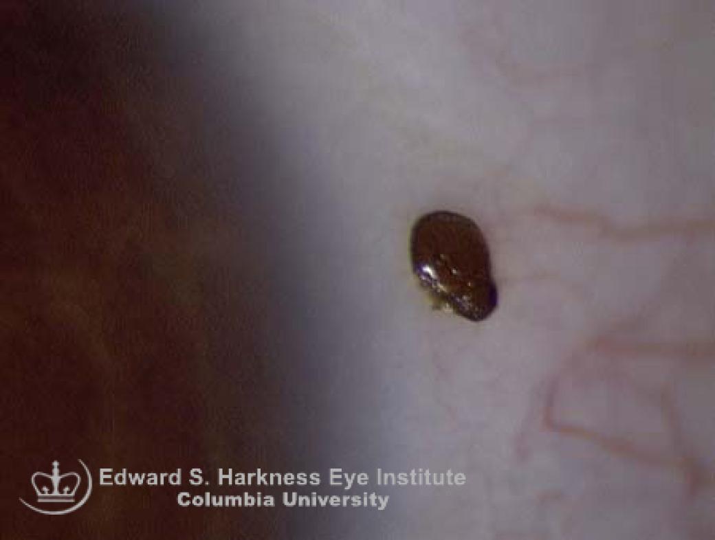 Conjunctival Foreign Body | Vagelos College of Physicians and Surgeons