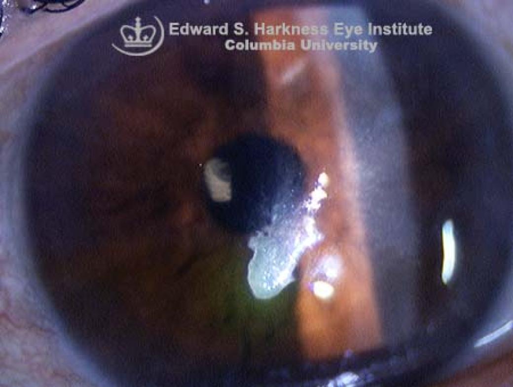 Corneal Intraepithelial Neoplasia | Vagelos College of Physicians and ...