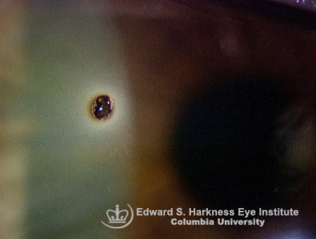 Corneal Foreign Body | Vagelos College of Physicians and Surgeons