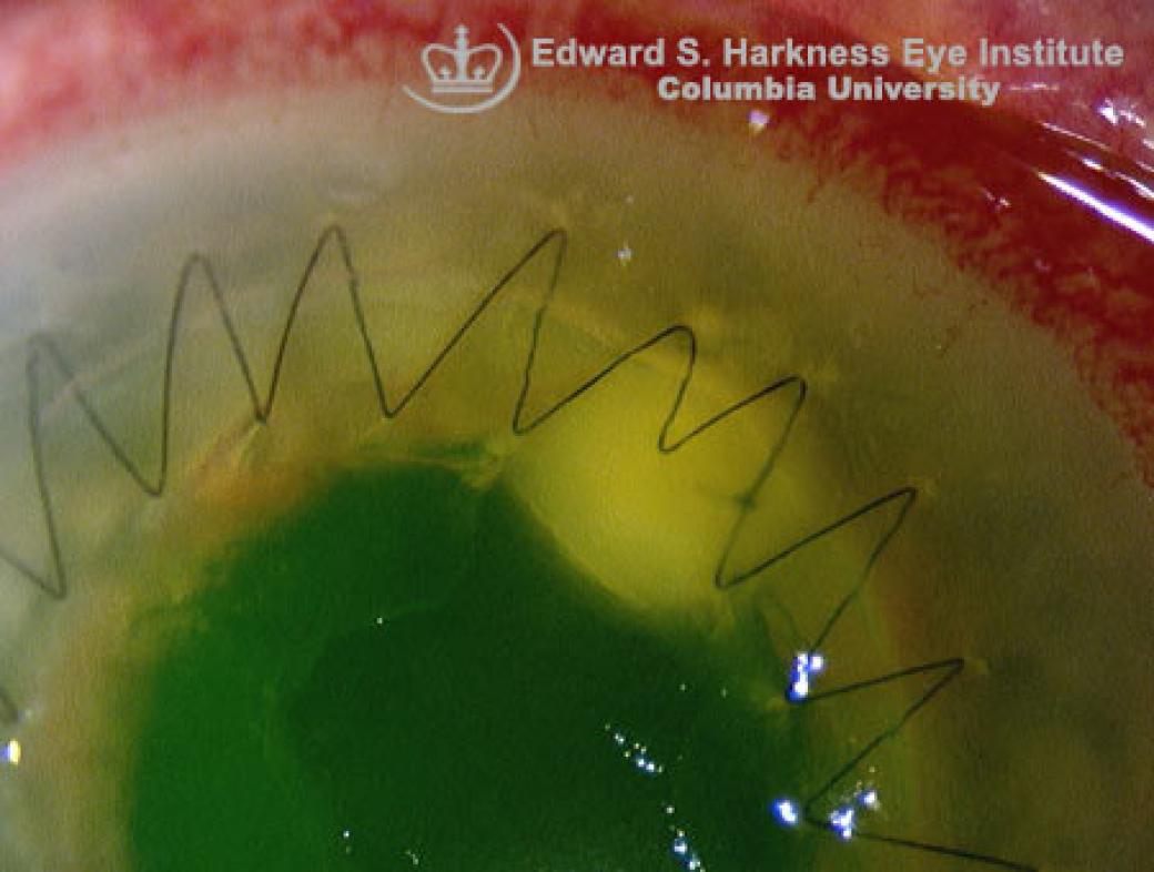 Corneal Infiltrate | Vagelos College of Physicians and Surgeons