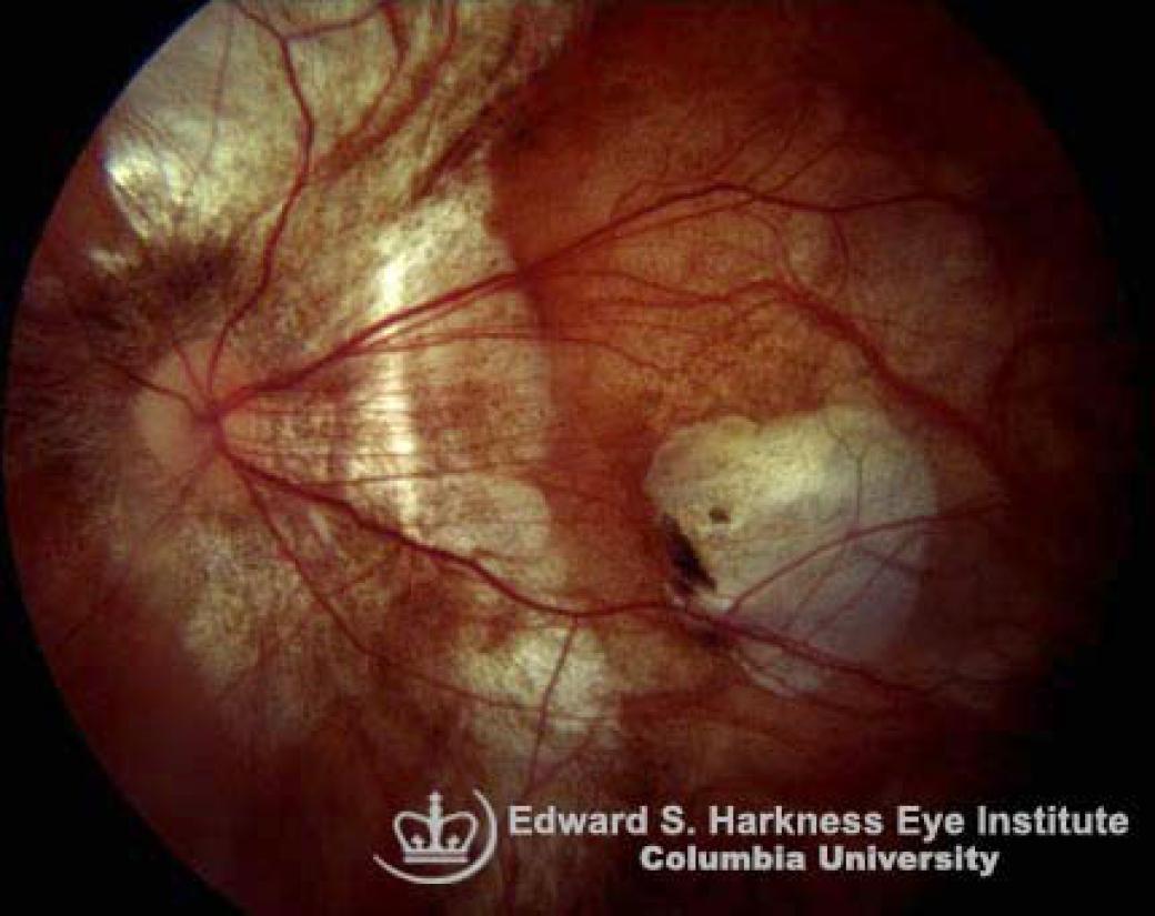 Degenerative Myopia | Vagelos College of Physicians and Surgeons