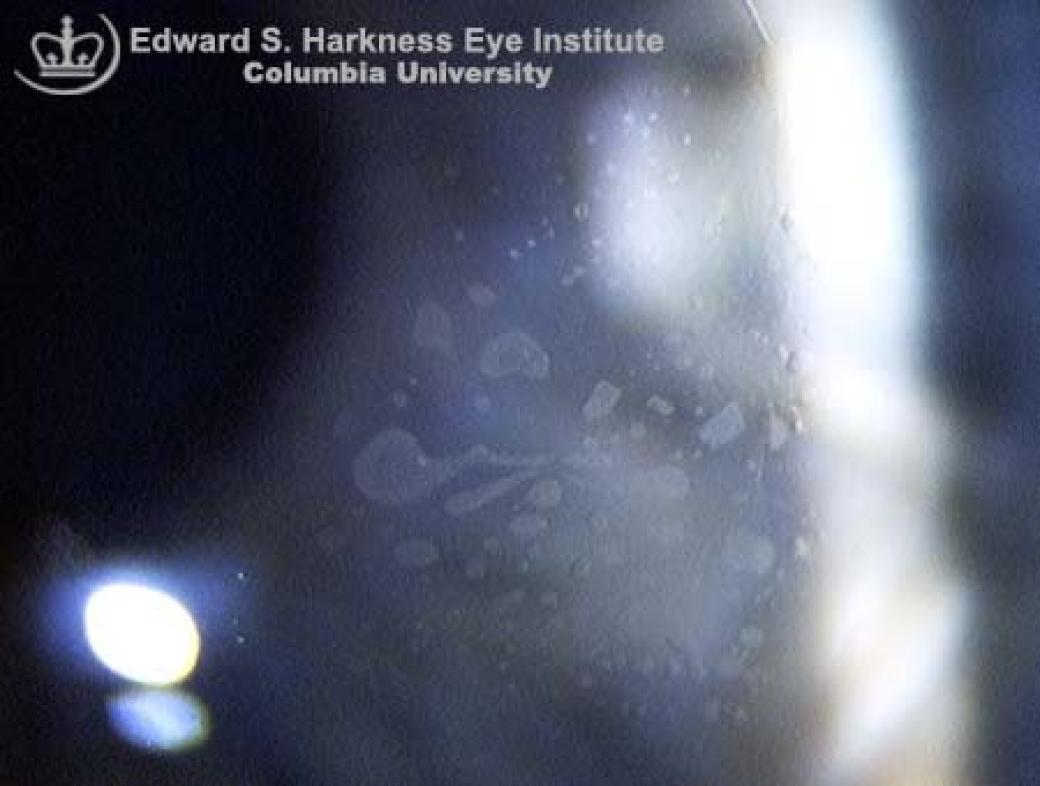 Epithelial Ingrowth | Vagelos College of Physicians and Surgeons