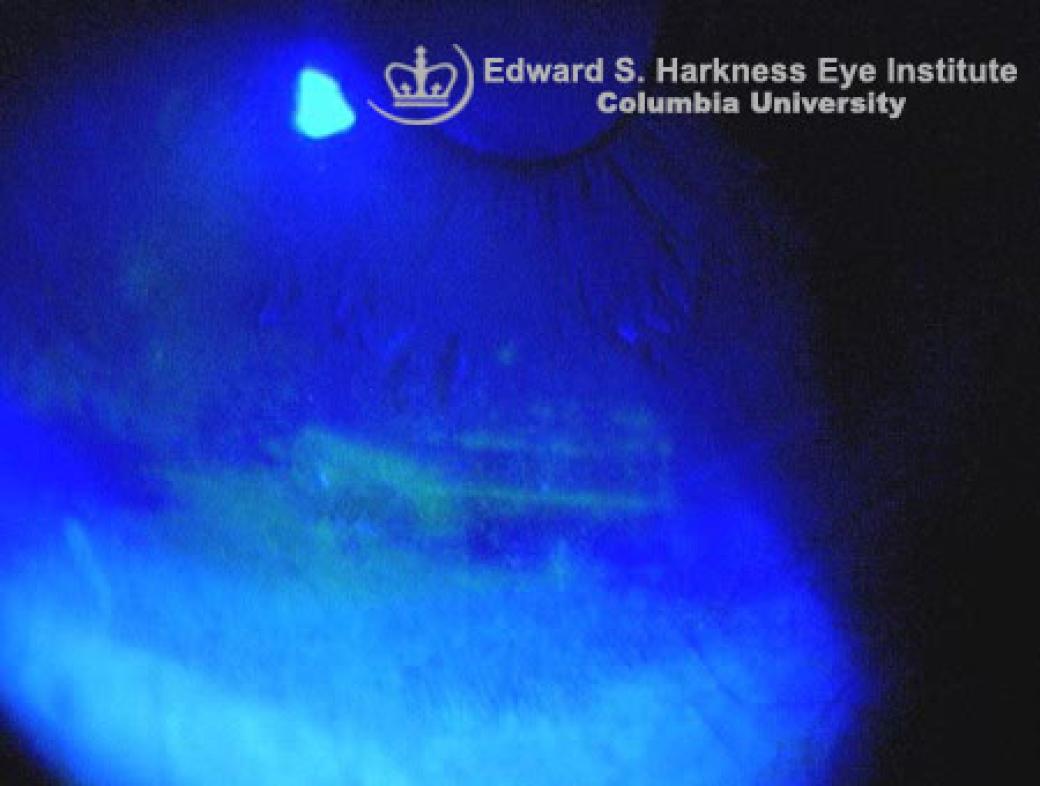 Exposure Keratitis | Vagelos College of Physicians and Surgeons