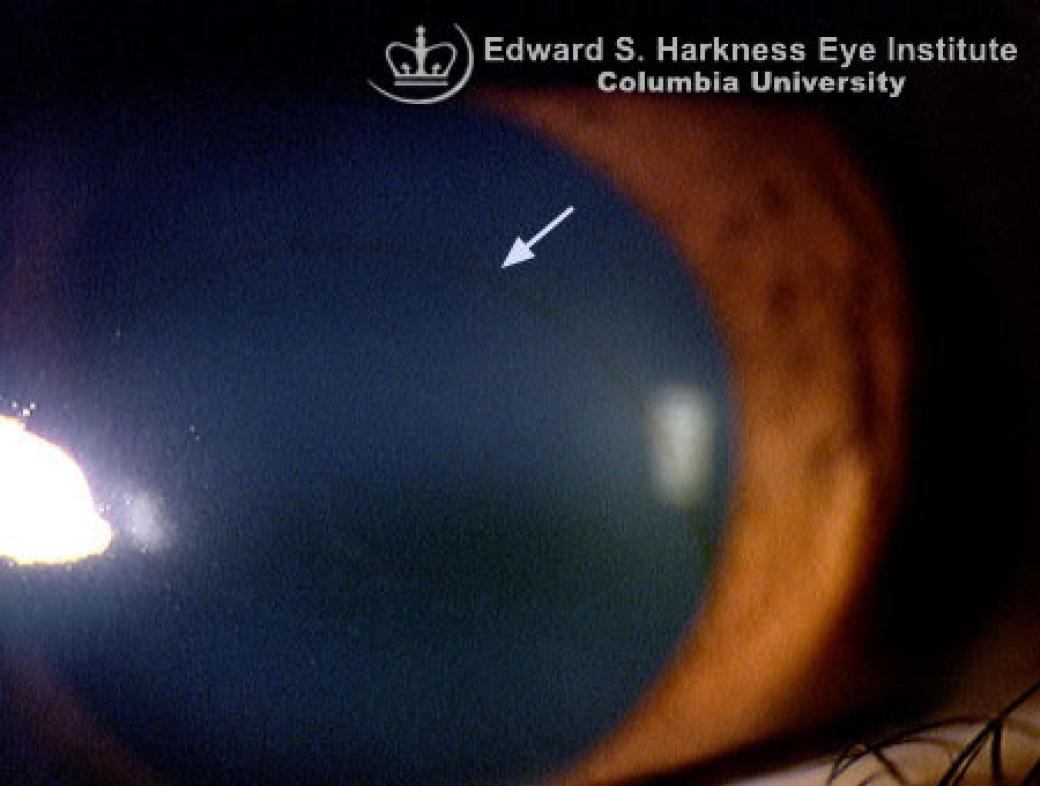 Fleischer's Ring | Vagelos College of Physicians and Surgeons