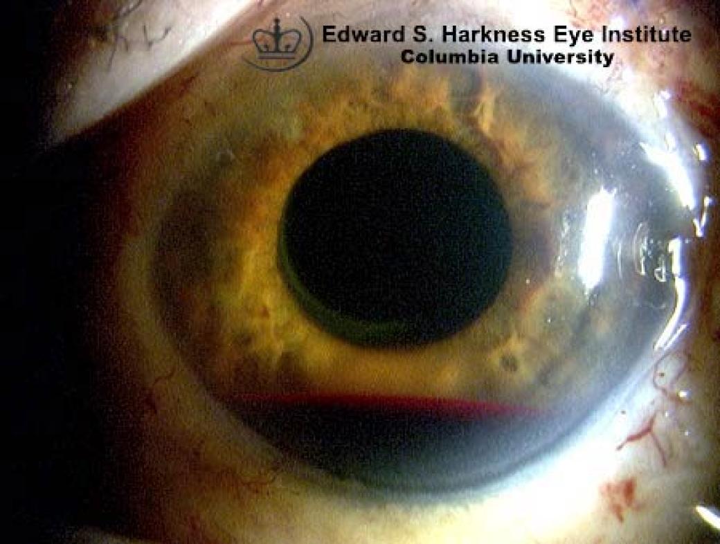 Hyphema | Vagelos College of Physicians and Surgeons