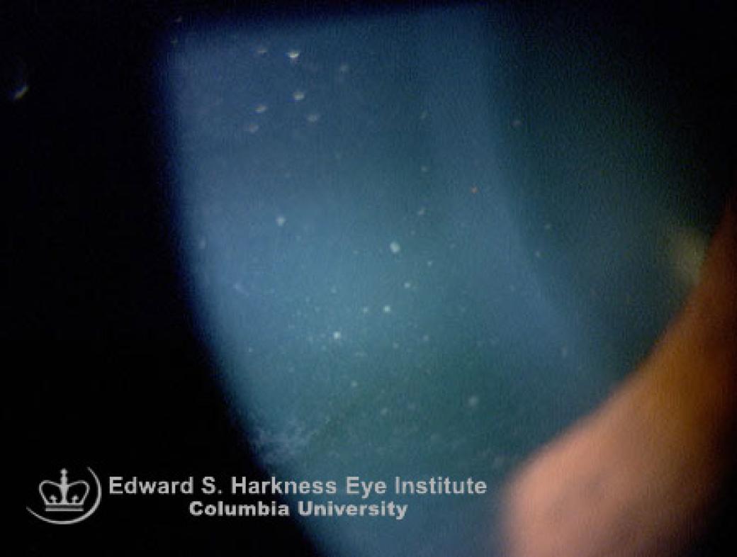 Keratic Precipitates | Vagelos College of Physicians and Surgeons