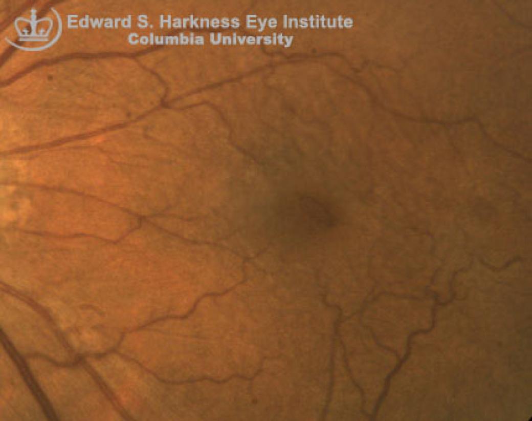 Macular Pucker | Vagelos College of Physicians and Surgeons