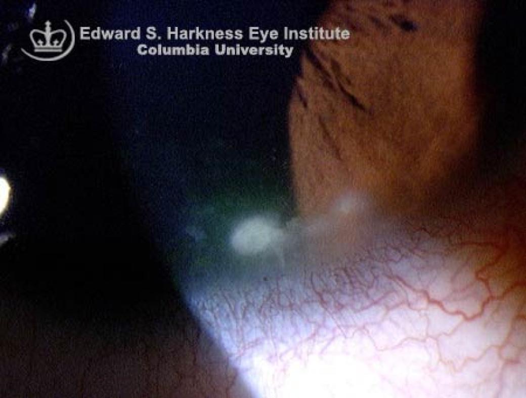 Marginal Keratitis | Vagelos College of Physicians and Surgeons