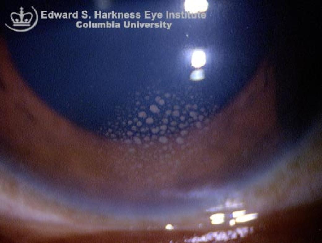 Mutton-fat keratic precipitates | Vagelos College of Physicians and ...