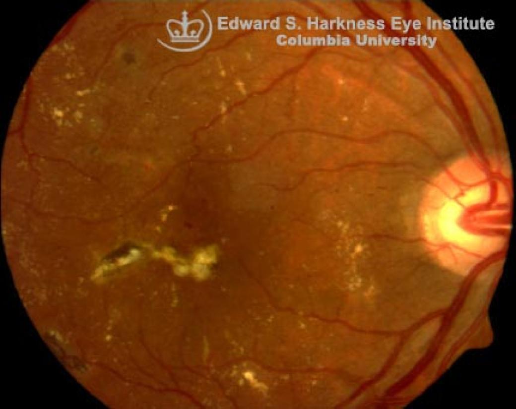 Nonproliferative Diabetic Retinopathy (NPDR) | Vagelos College of ...