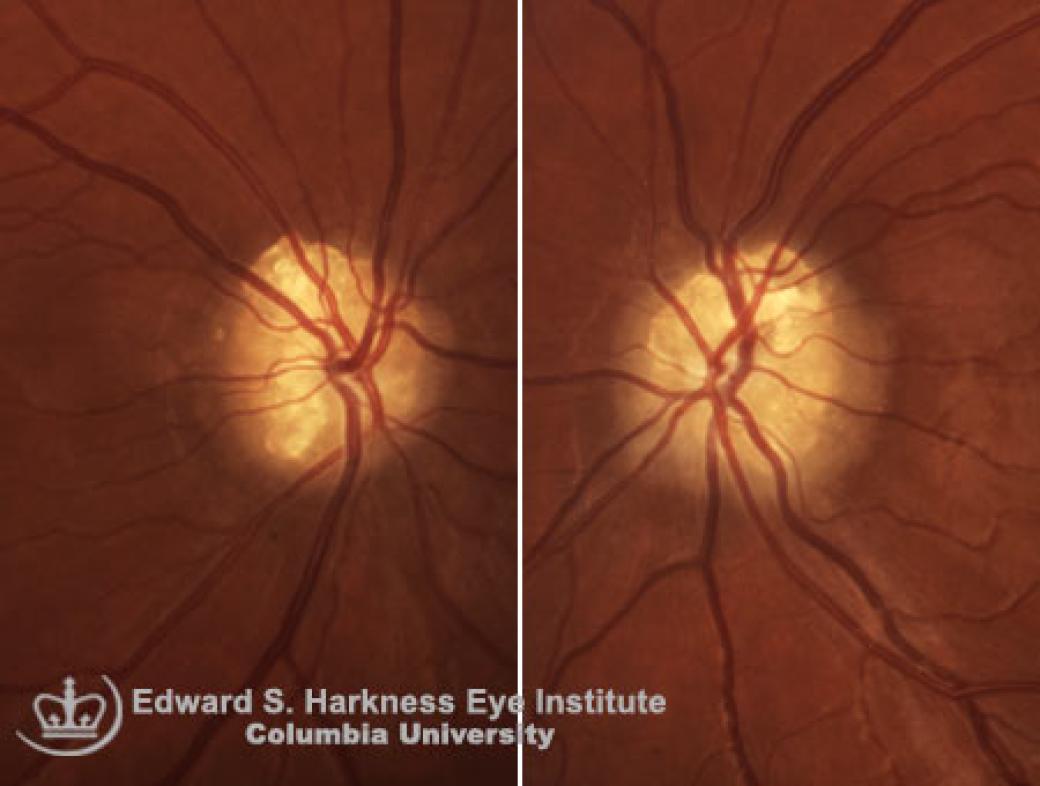 Optic Nerve Drusen | Vagelos College of Physicians and Surgeons