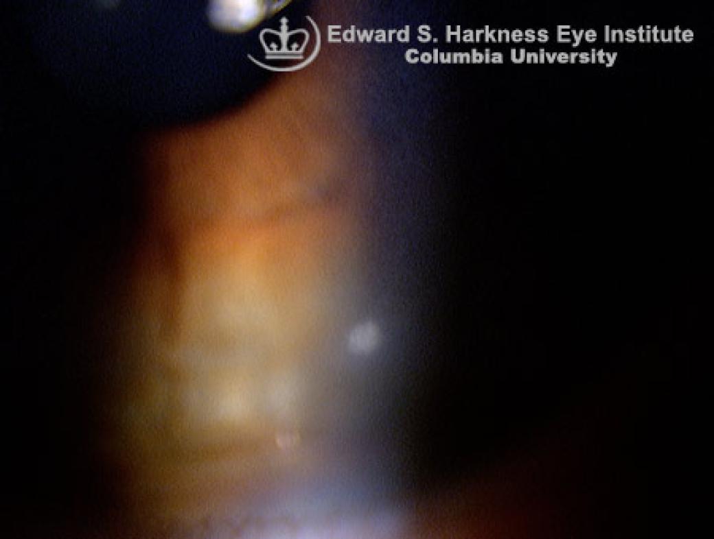 Peripheral Corneal Infiltrate | Vagelos College of Physicians and Surgeons