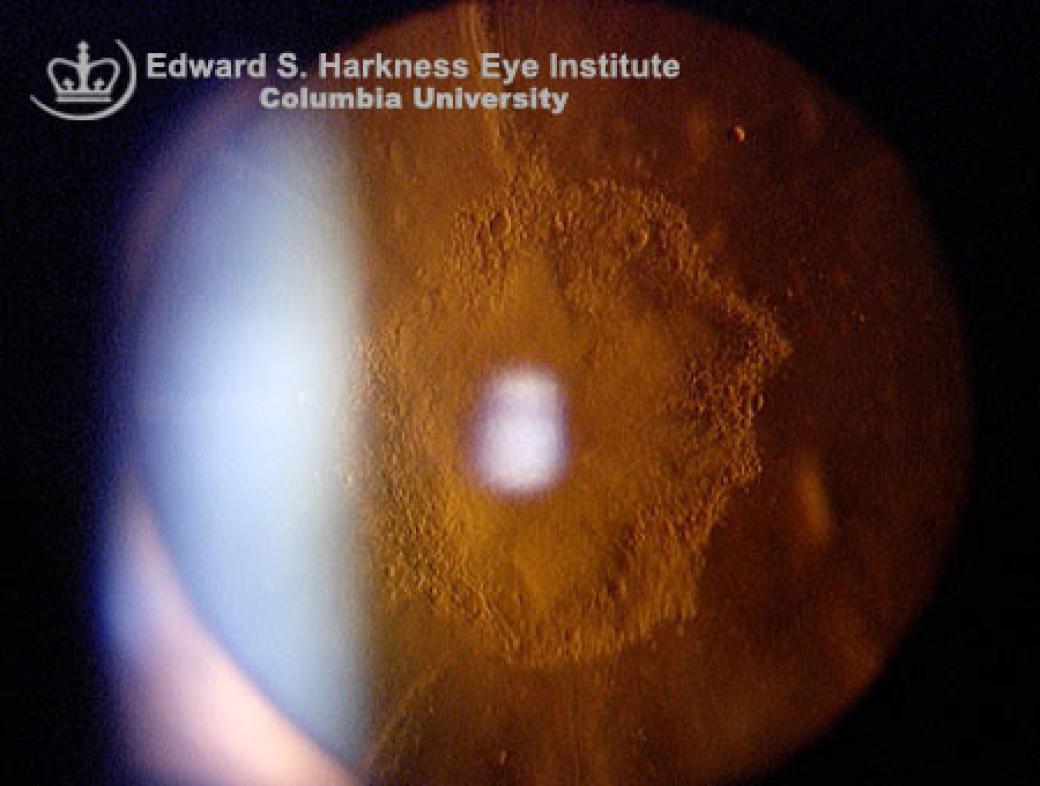 Posterior Subcapsular | Vagelos College of Physicians and Surgeons