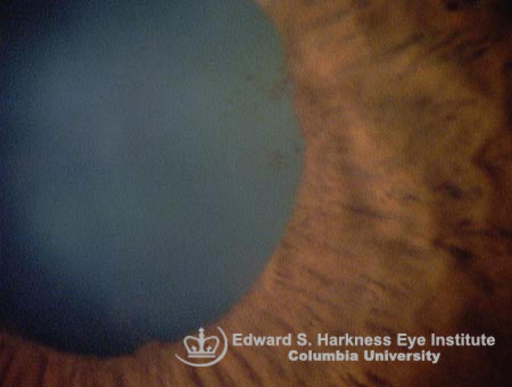 Posterior Synechiae | Vagelos College of Physicians and Surgeons