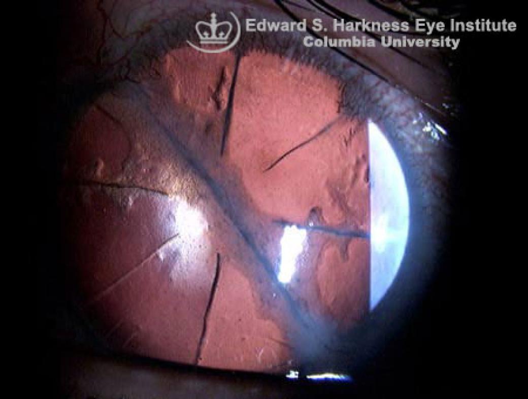 Radial Keratotomy Complication | Vagelos College of Physicians and Surgeons