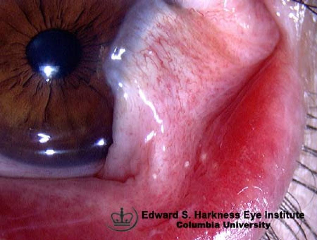 Recurrent Pterygium | Vagelos College of Physicians and Surgeons