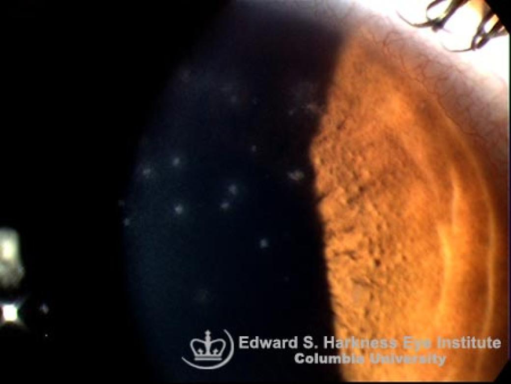 Thygeson's Superficial Punctate Keratitis | Vagelos College of ...