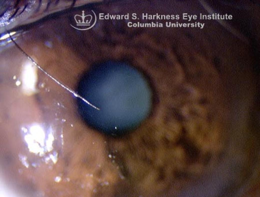 Trichiasis | Vagelos College of Physicians and Surgeons
