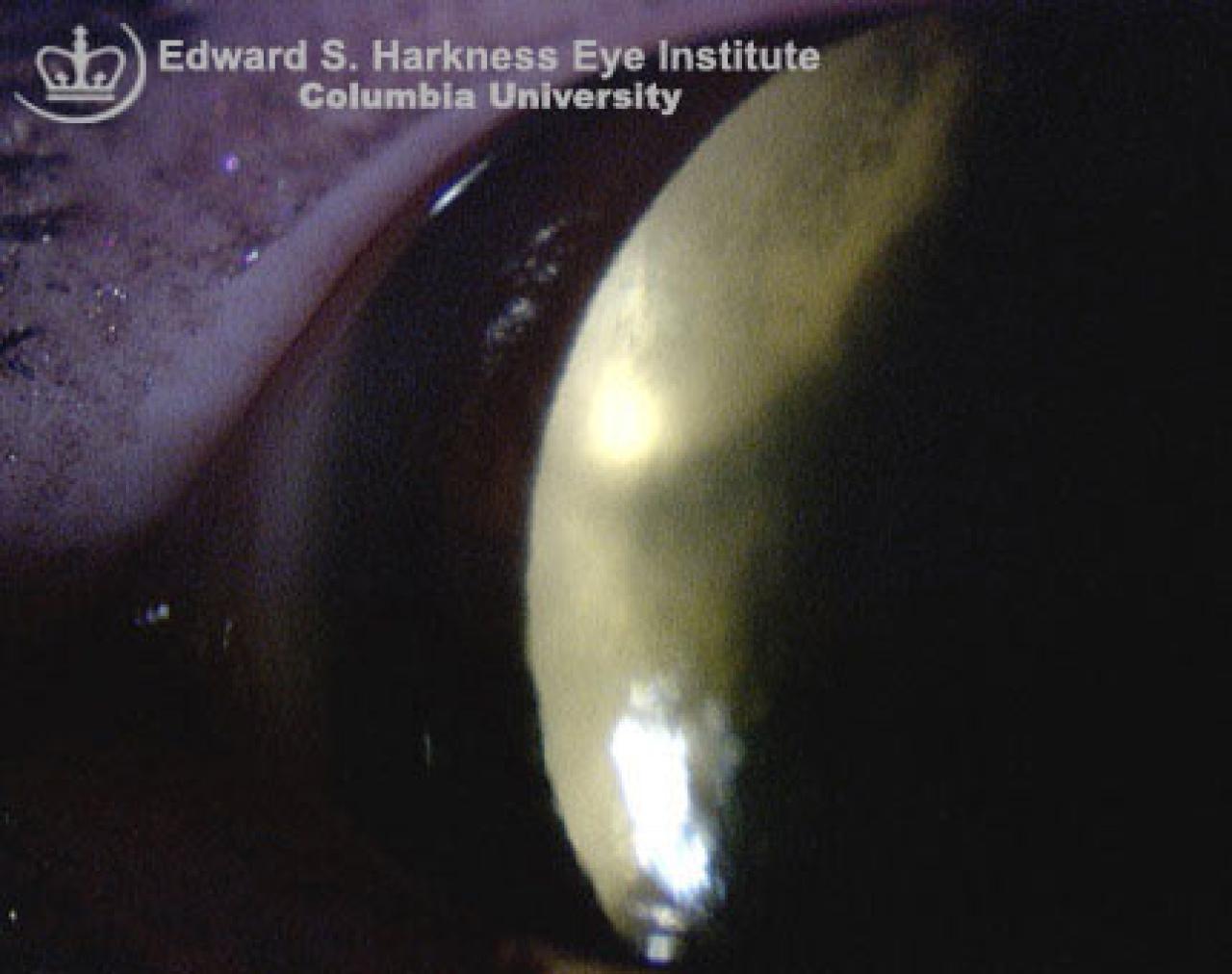 Intravitreous Depo Steroid Injection | Vagelos College of Physicians ...