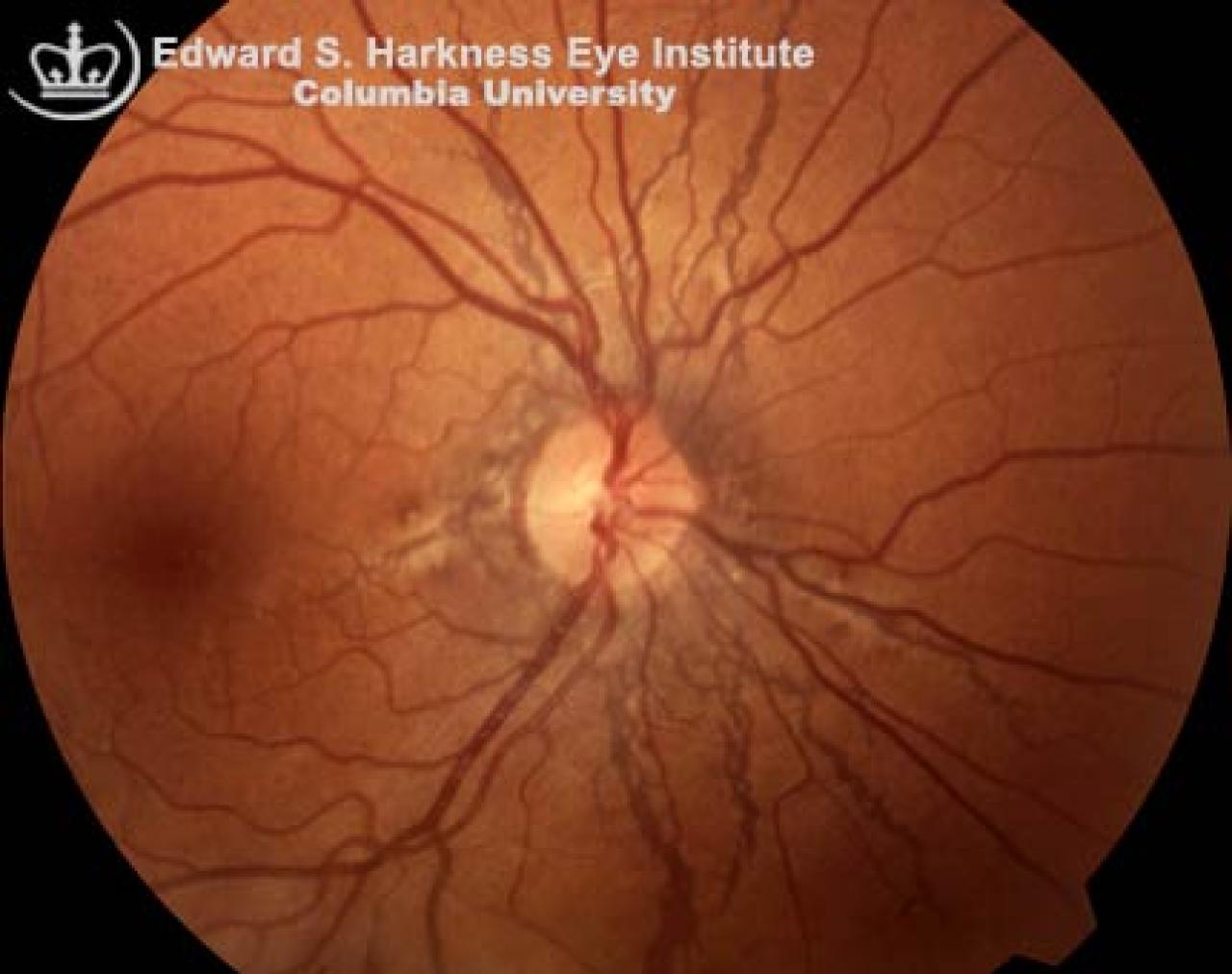 Angioid Streaks | Vagelos College of Physicians and Surgeons