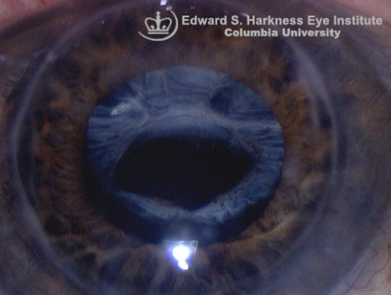 Anterior Capsulorhexis Contracture | Vagelos College of Physicians and ...