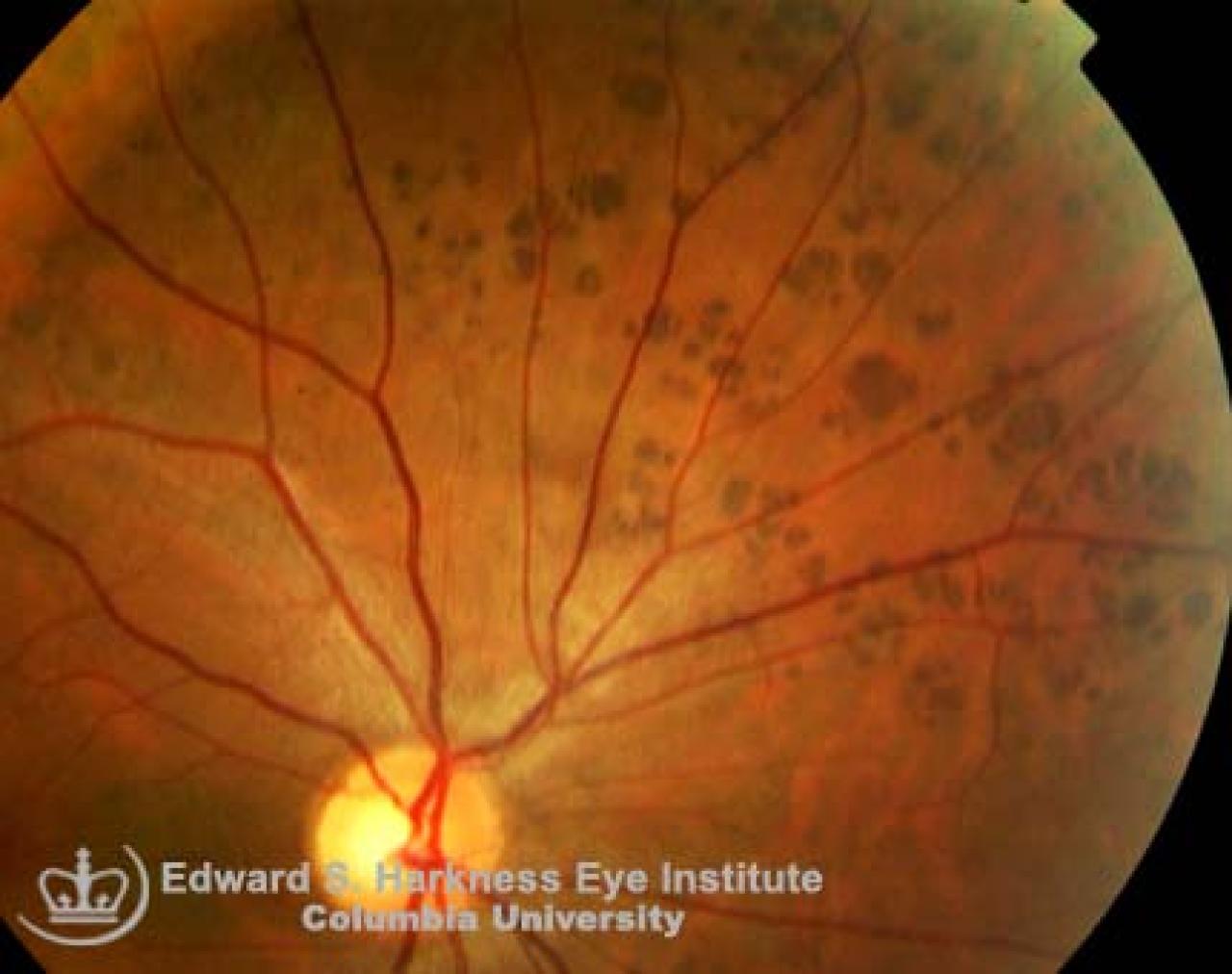 "Bear Tracks" CHRPE | Vagelos College of Physicians and Surgeons