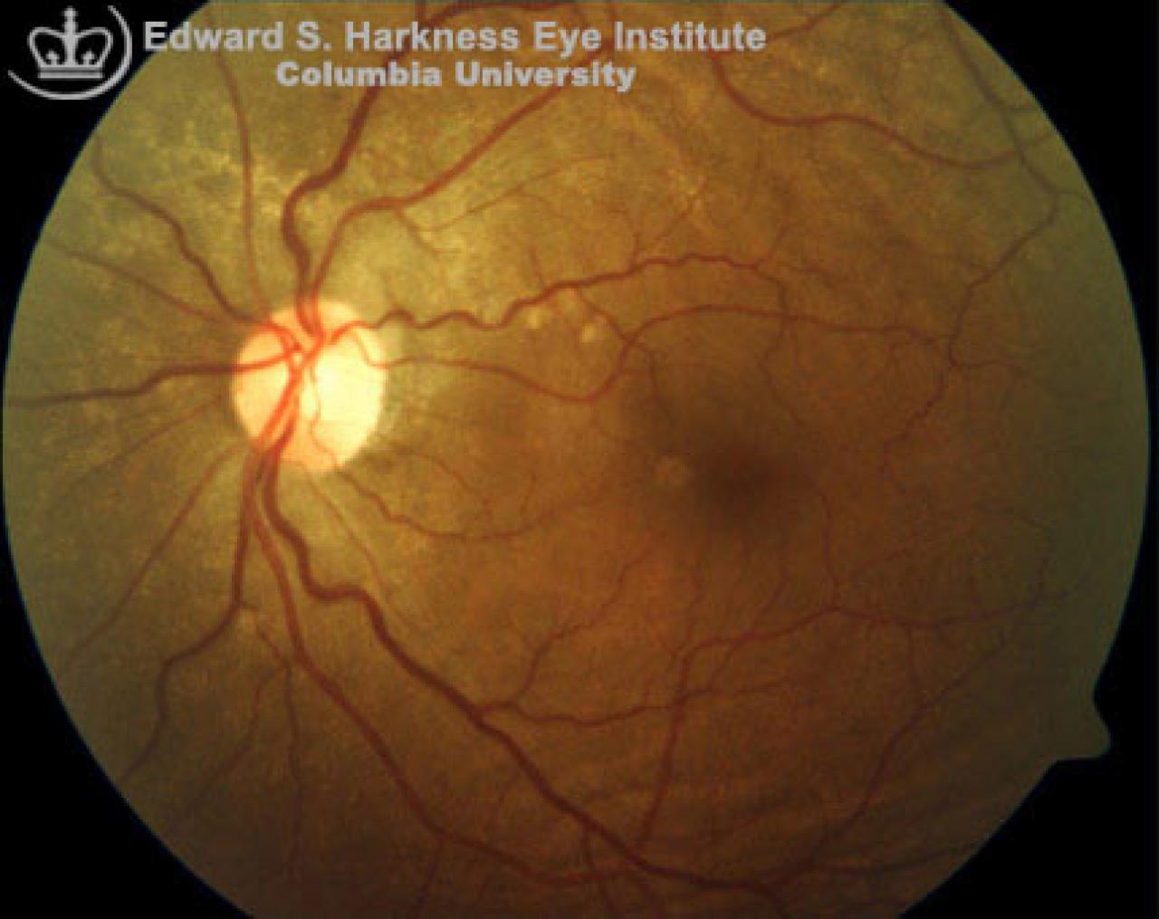 Chorioretinal Folds | Vagelos College of Physicians and Surgeons