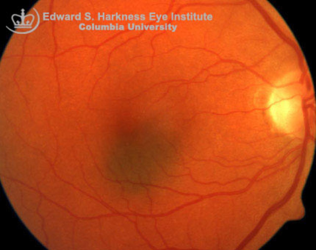 Choroidal Nevus | Vagelos College of Physicians and Surgeons