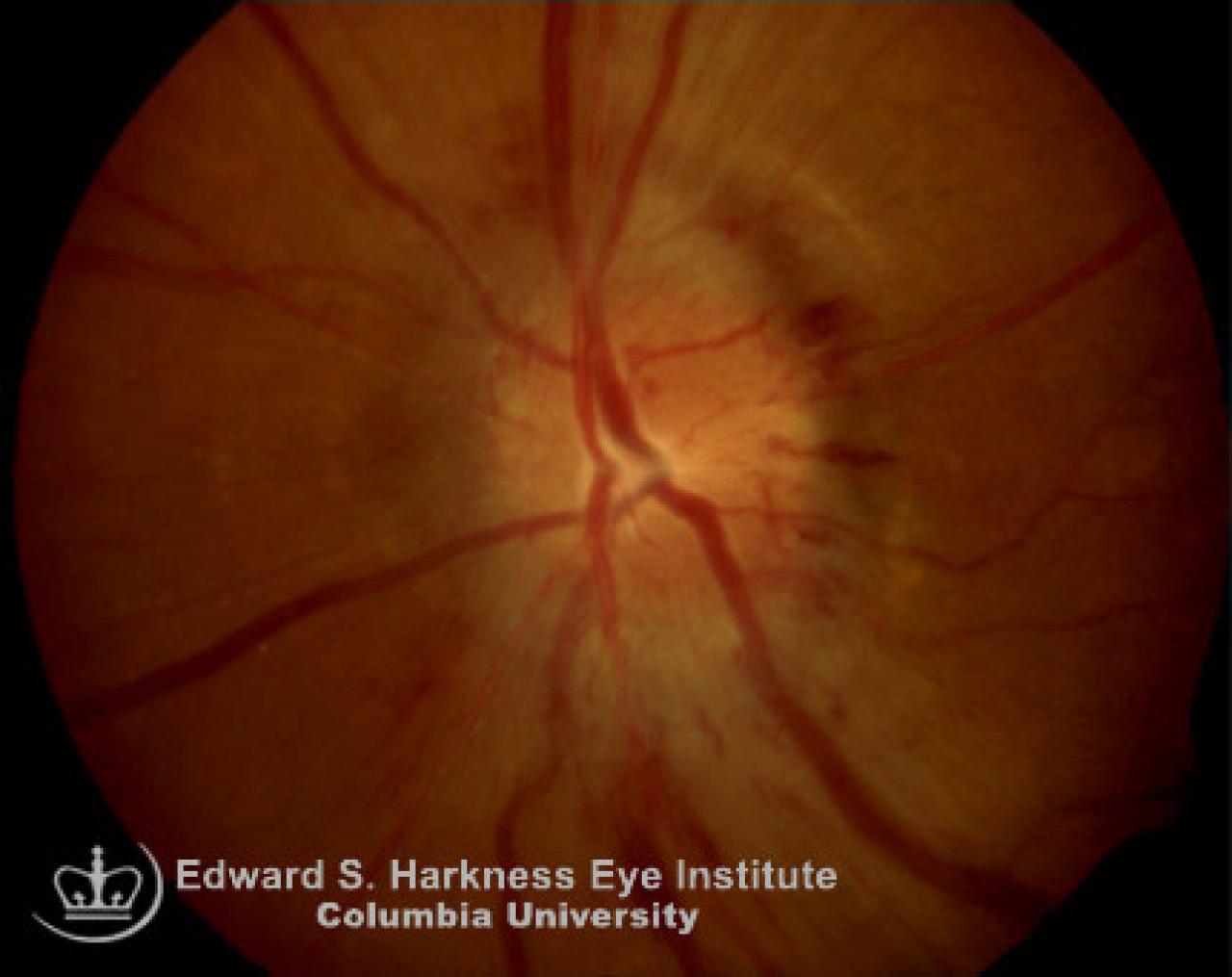 Diabetic Papillopathy | Vagelos College of Physicians and Surgeons
