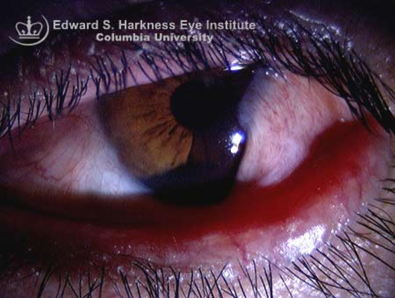 Ectropion | Vagelos College of Physicians and Surgeons