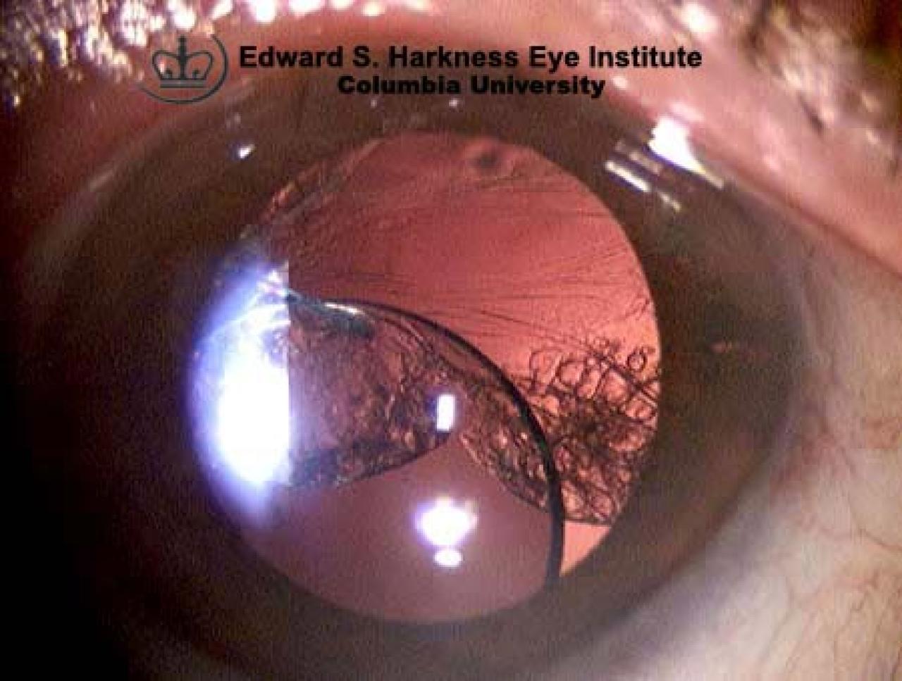 Elschnig's Pearls | Vagelos College of Physicians and Surgeons